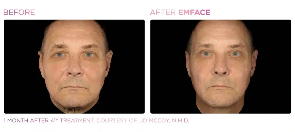 Emface | Non-Surgical Face Lift In Montclair, NJ