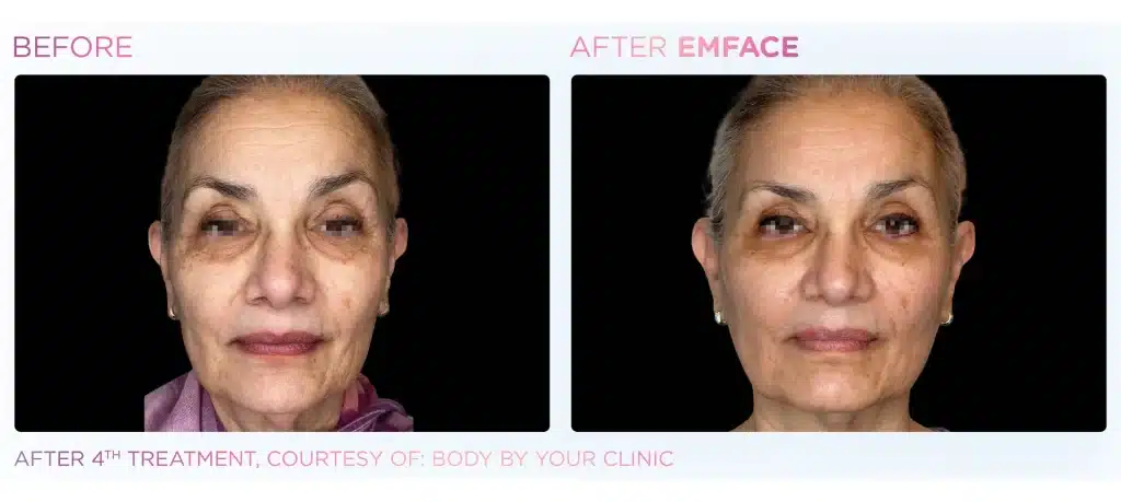 Emface | Non-Surgical Face Lift In Montclair, NJ
