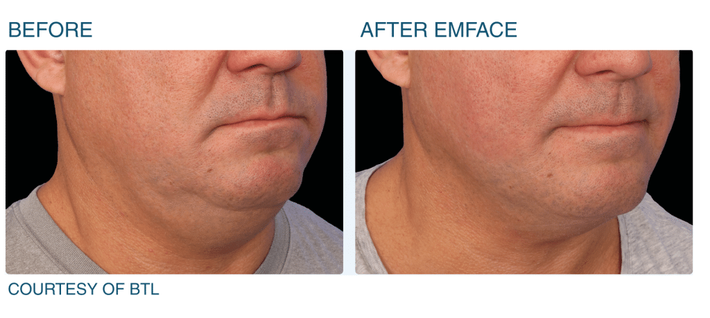 Emface Before And After Pictures | Real Emface Results